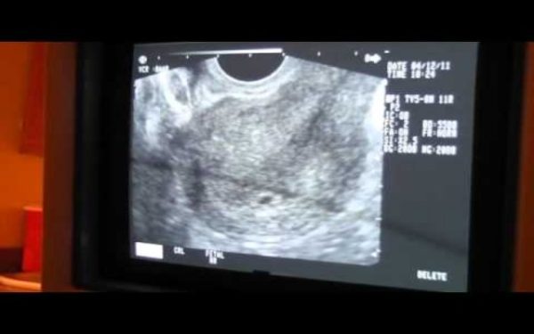 Ultrasonido temprano en el embarazo